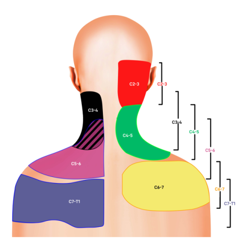 Referred Pain – The Cervical Spine - Kamloops Physiotherapy